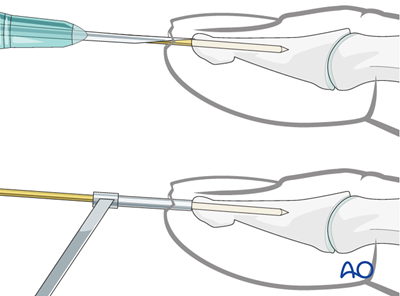 K-wire fixation for Distal phalanx, distal and shaft, multifragmentary
