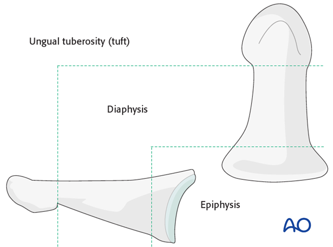 Distal phalanx, distal and shaft, multifragmentary