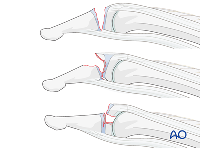 Distal phalanx, distal and shaft, transverse