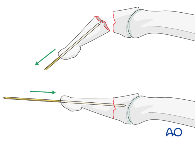 K-wire fixation for Distal phalanx, distal and shaft, transverse