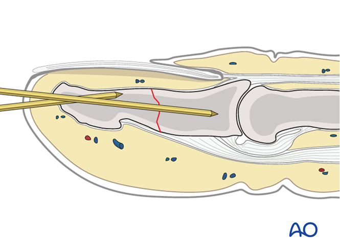 K-wire fixation for Distal phalanx, distal and shaft, transverse