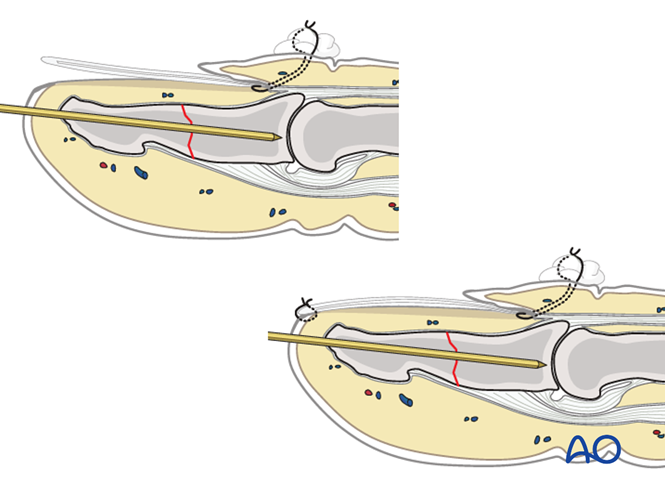 K-wire fixation for Distal phalanx, distal and shaft, transverse
