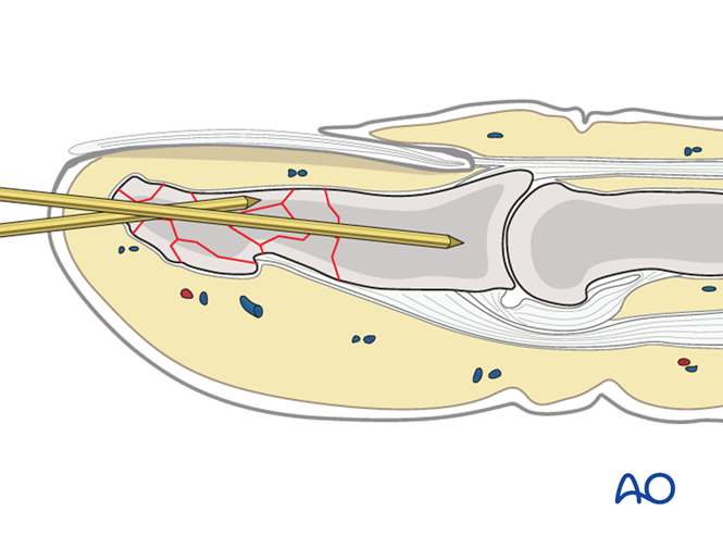 K-wire fixation for Distal phalanx, distal and shaft, multifragmentary