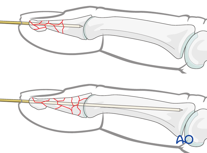 K-wire fixation for Distal phalanx, distal and shaft, multifragmentary