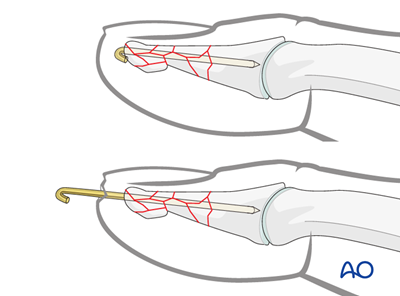 K-wire fixation for Distal phalanx, distal and shaft, multifragmentary
