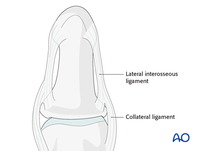 Distal phalanx, distal and shaft, multifragmentary