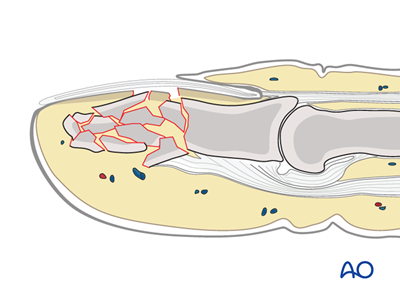 Distal phalanx, distal and shaft, multifragmentary