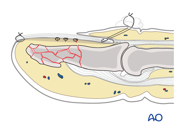 K-wire fixation for Distal phalanx, distal and shaft, multifragmentary