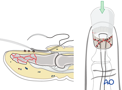 K-wire fixation for Distal phalanx, distal and shaft, multifragmentary