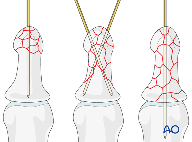 K-wire fixation for Distal phalanx, distal and shaft, multifragmentary