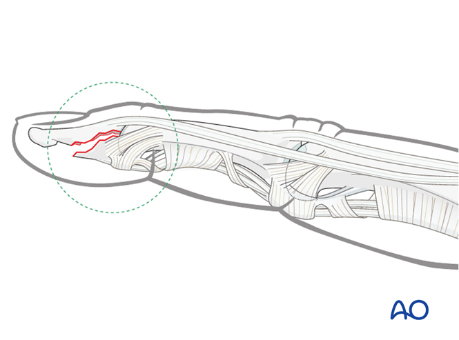 K Wire Fixation For Distal Phalanx Base Palmar Avulsion