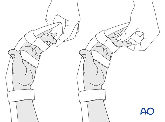 Suture fixation for Distal phalanx, base, palmar avulsion