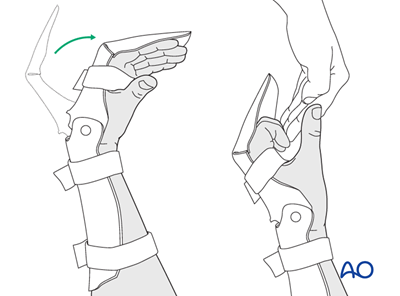 Suture fixation for Proximal, palmar avulsion