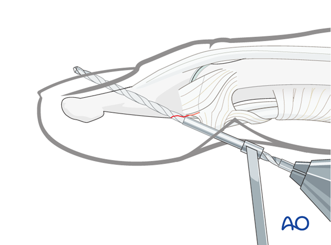 Suture fixation for Distal phalanx, base, palmar avulsion
