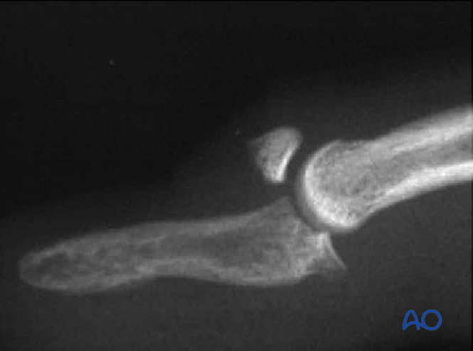 Nonoperative treatment for Distal phalanx, base, dorsal avulsion