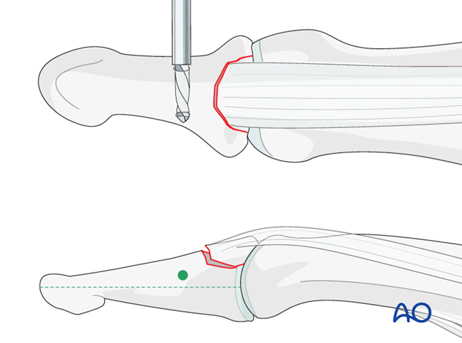 Tension-band wire for Distal phalanx, base, dorsal avulsion