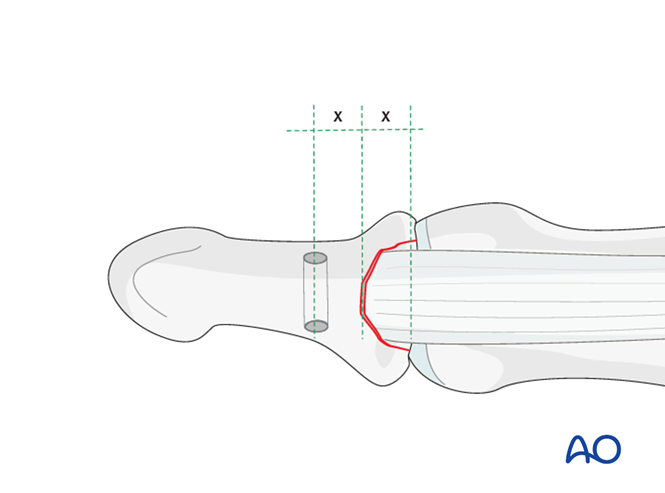 Tension-band wire for Distal phalanx, base, dorsal avulsion