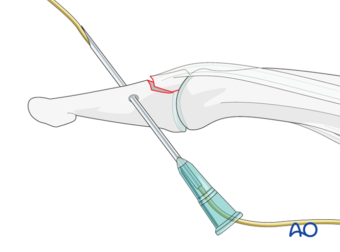 Tension-band wire for Distal phalanx, base, dorsal avulsion