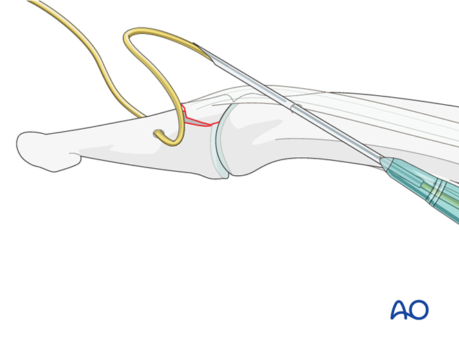 Tension-band wire for Distal phalanx, base, dorsal avulsion