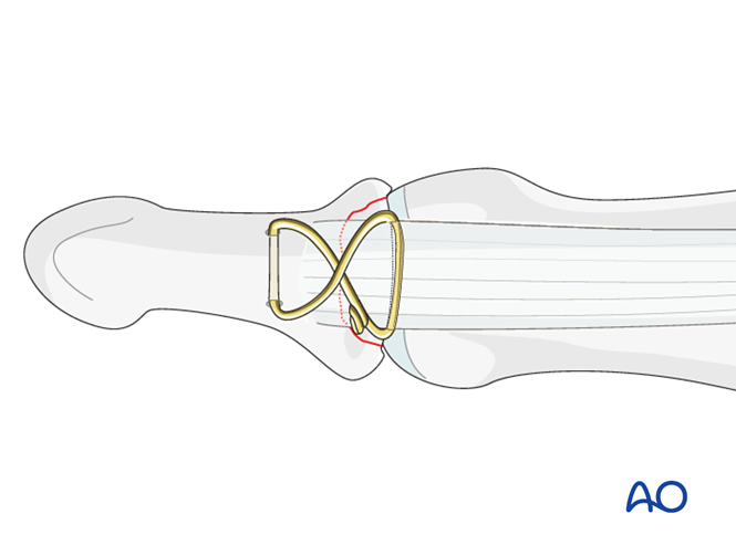 Tension-band wire for Distal phalanx, base, dorsal avulsion