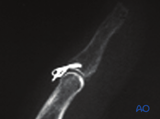 Tension-band wire for Distal phalanx, base, dorsal avulsion