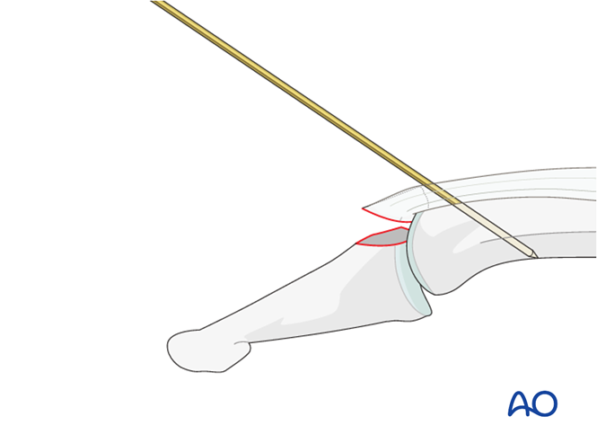 K-wire fixation for Distal phalanx, base, dorsal avulsion