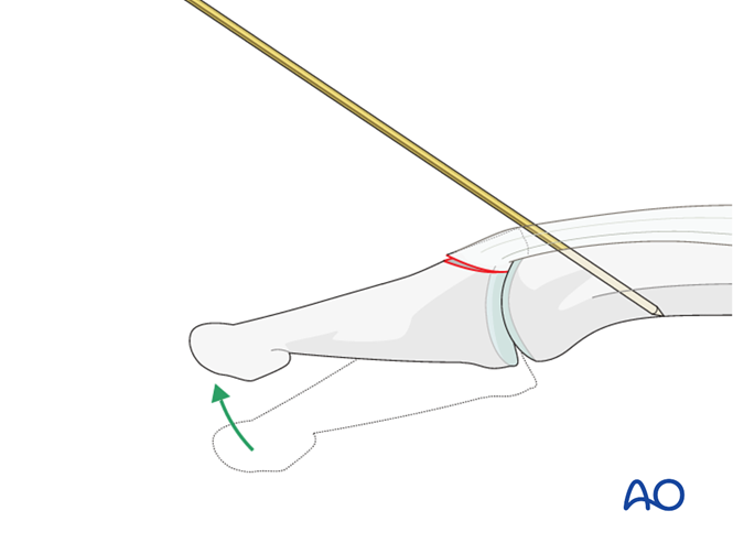 K-wire fixation for Distal phalanx, base, dorsal avulsion