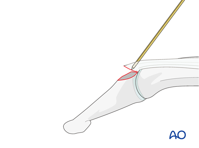 K-wire fixation for Distal phalanx, base, dorsal avulsion