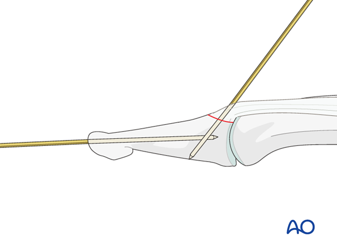 K-wire fixation for Distal phalanx, base, dorsal avulsion