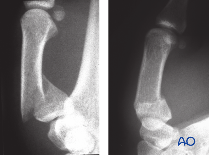 Metacarpal, base