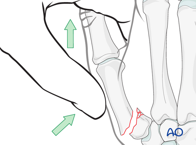 Locking compression plate (LCP) fixation for Metacarpal, base