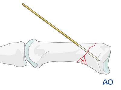 Locking compression plate (LCP) fixation for Metacarpal, base