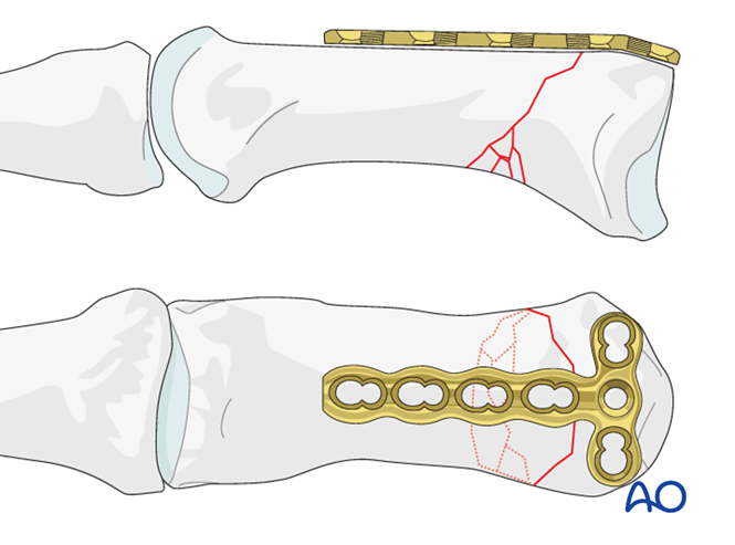 Locking compression plate (LCP) fixation for Metacarpal, base