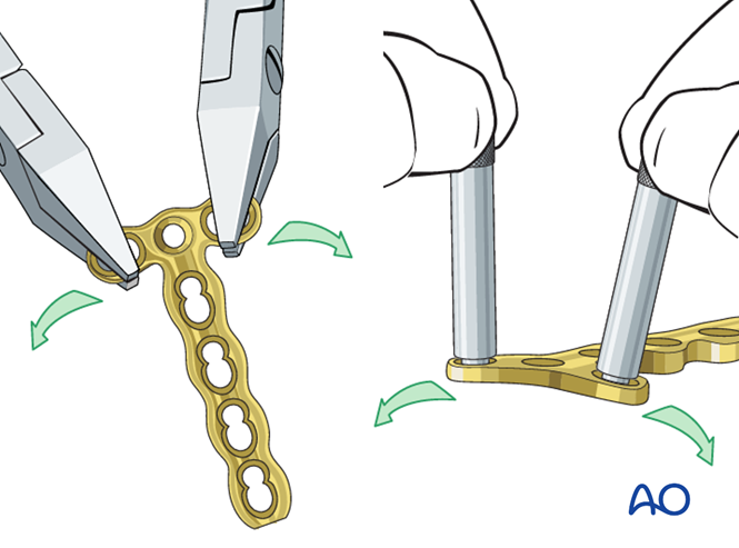 Locking compression plate (LCP) fixation for Metacarpal, base