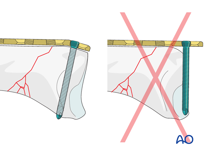 Locking compression plate (LCP) fixation for Metacarpal, base