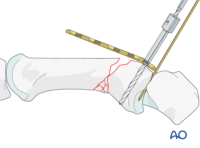 Locking compression plate (LCP) fixation for Metacarpal, base
