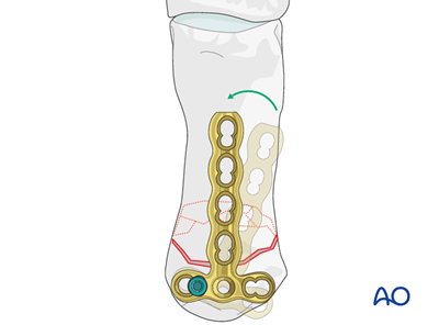 Locking compression plate (LCP) fixation for Metacarpal, base