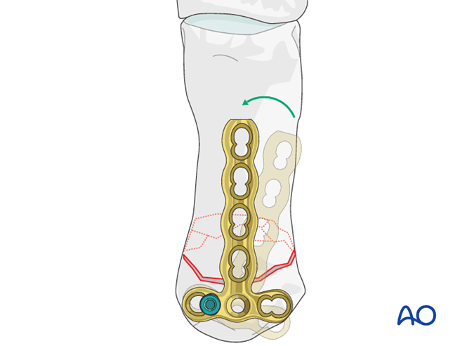 Locking compression plate (LCP) fixation for Metacarpal, base