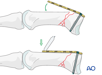 Locking compression plate (LCP) fixation for Metacarpal, base