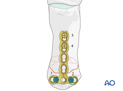 Locking compression plate (LCP) fixation for Metacarpal, base