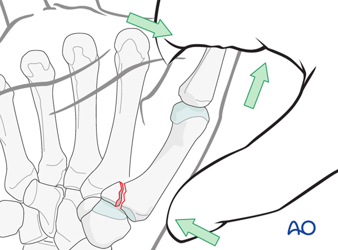 K-wire fixation for Metacarpal, Bennett fracture