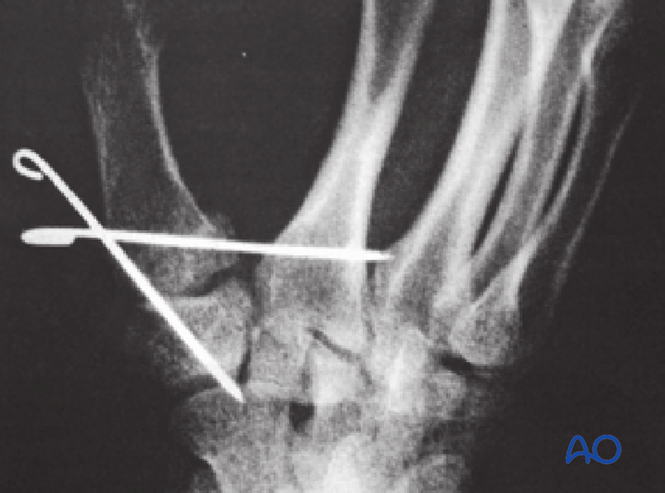 K-wire fixation for Metacarpal, Bennett fracture