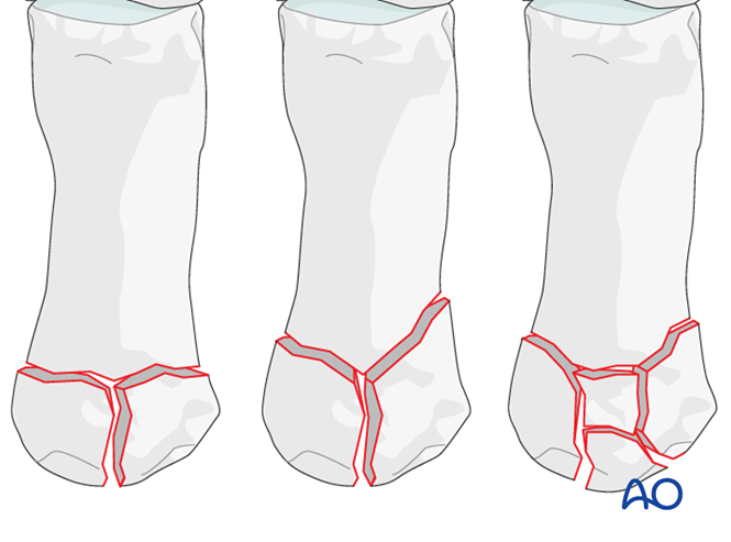Metacarpal, Rolando fracture
