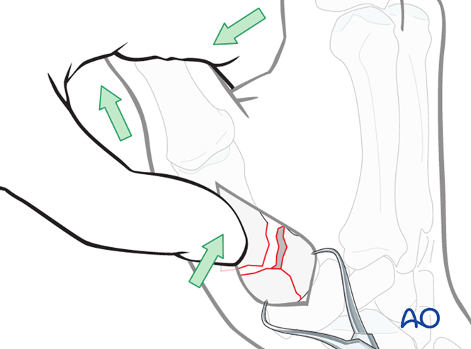 Plate fixation for Metacarpal, Rolando fracture