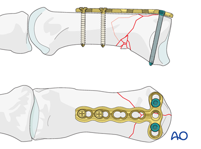 Plate fixation for Metacarpal, Rolando fracture