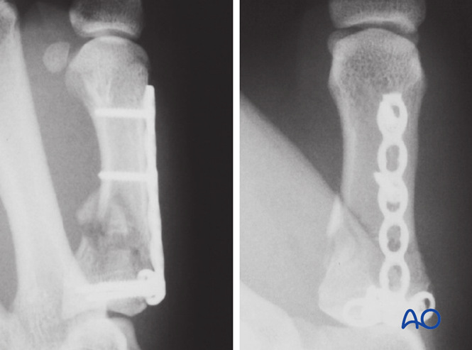 Plate fixation for Metacarpal, Rolando fracture