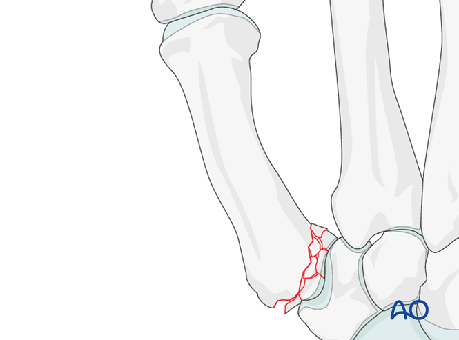 External fixation for Metacarpal, base