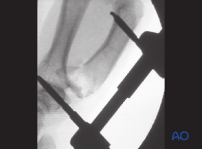 External fixation for Metacarpal, base