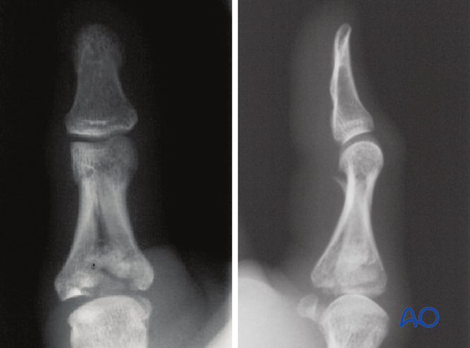 Open reduction, internal fixation (ORIF) for Proximal phalanx, base and ...