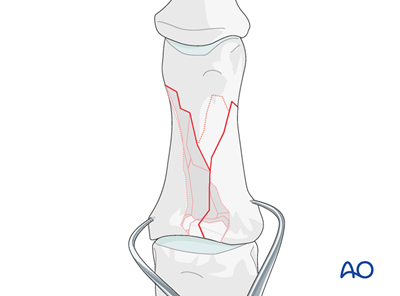 Open reduction, internal fixation (ORIF) for Proximal phalanx, base and ...